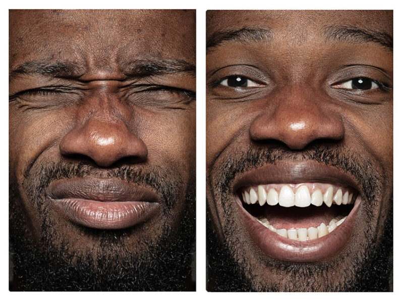 Dentist in San Francisco, CA - Smile Gallery Bliss Dental SF | Before ...